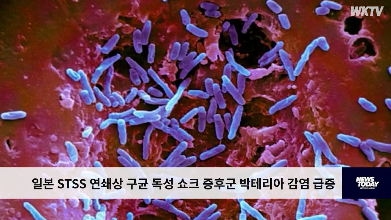 일본 STSS 연쇄상구균 독성 쇼크 증후군 박테리아 감염 급증 – 워싱턴지역(DC,VA,MD) 유일한 한인방송 WKTV